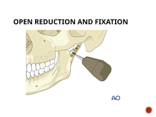 condylar fracture in oral and maxillofacial surgery | PPTX