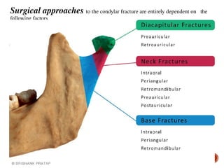 condylar fracture in oral and maxillofacial surgery | PPTX