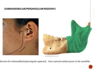 condylar fracture in oral and maxillofacial surgery | PPTX