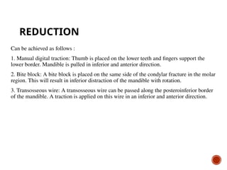condylar fracture in oral and maxillofacial surgery | PPTX
