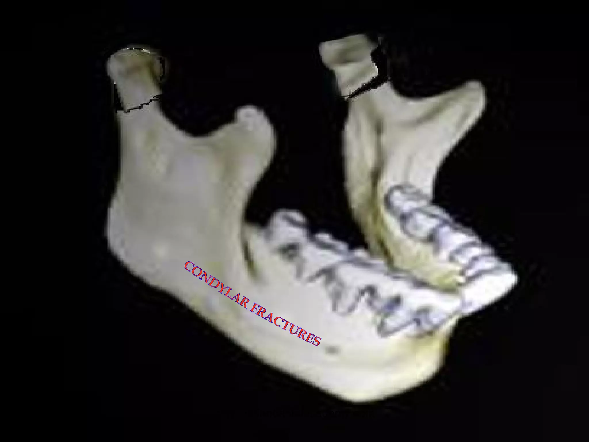 Condylar fractures /certified fixed orthodontic courses by Indian ...