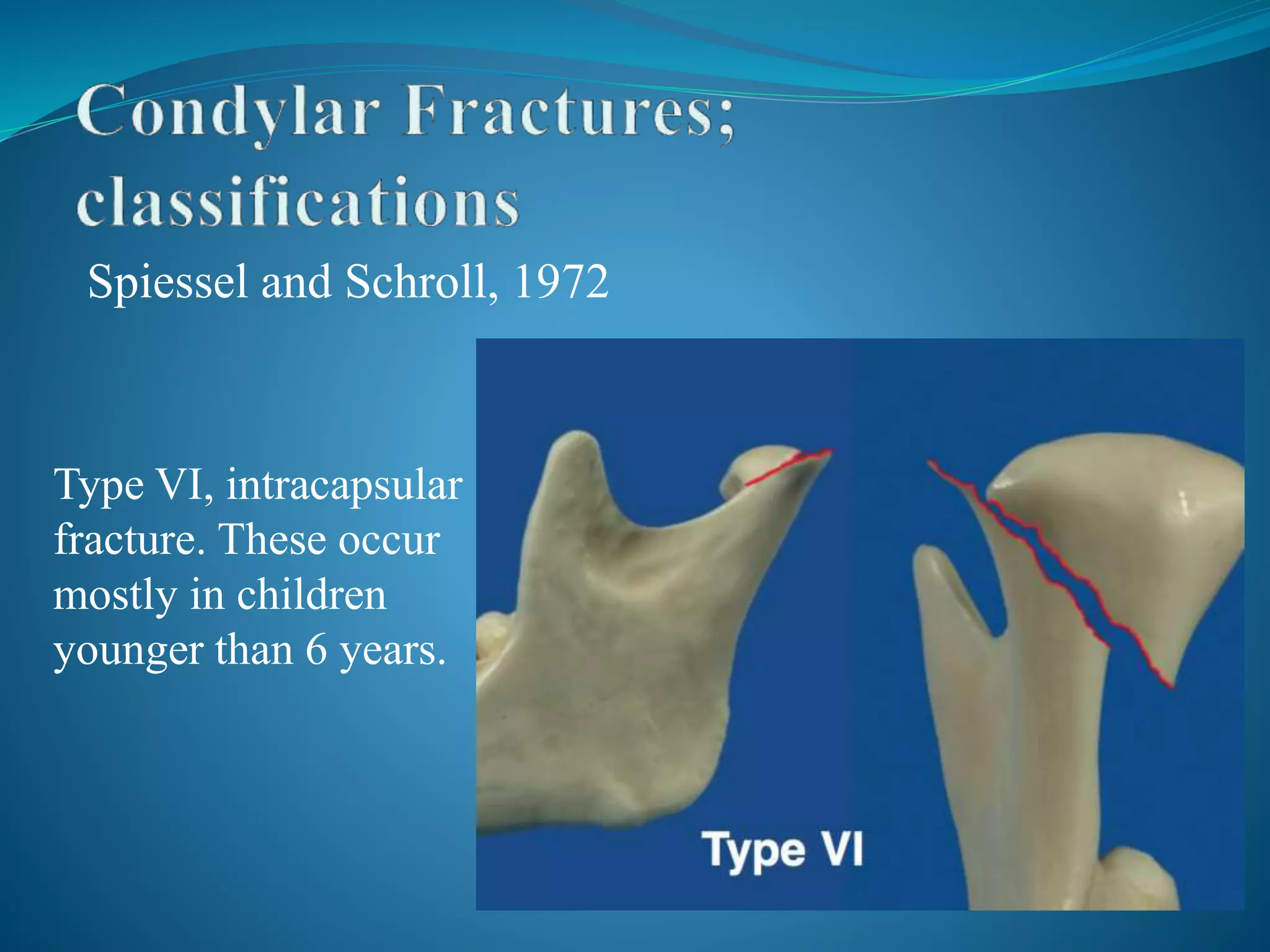 Condylar Fractures | PPTX