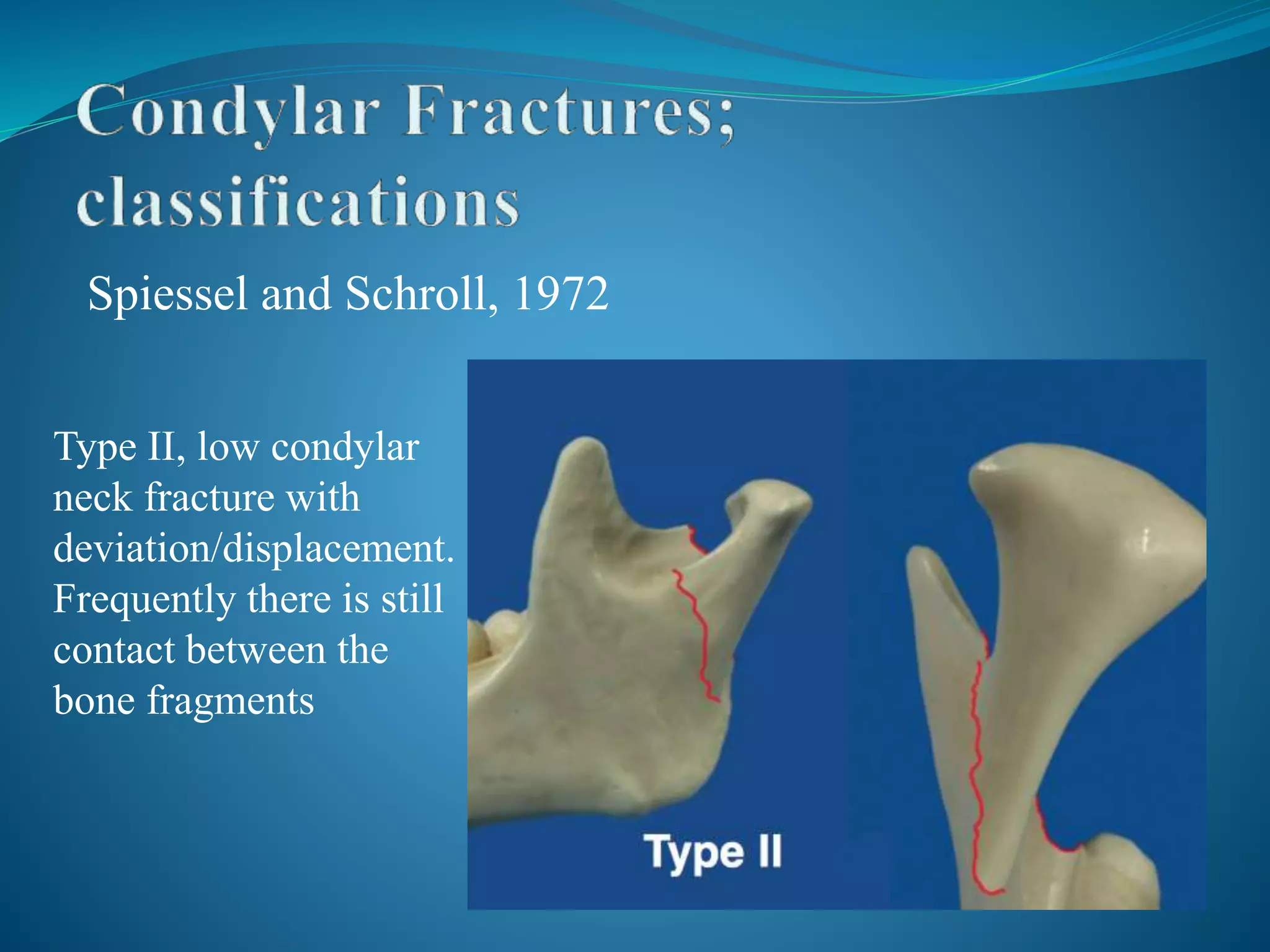 Condylar Fractures | PPTX