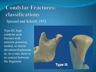 Condylar Fractures | PPTX