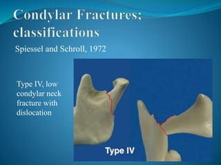 Condylar Fractures | PPTX