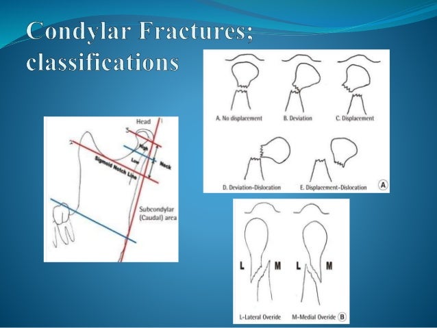 Condylar Fractures