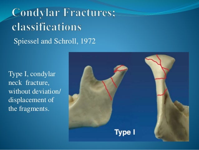 Condylar Fractures