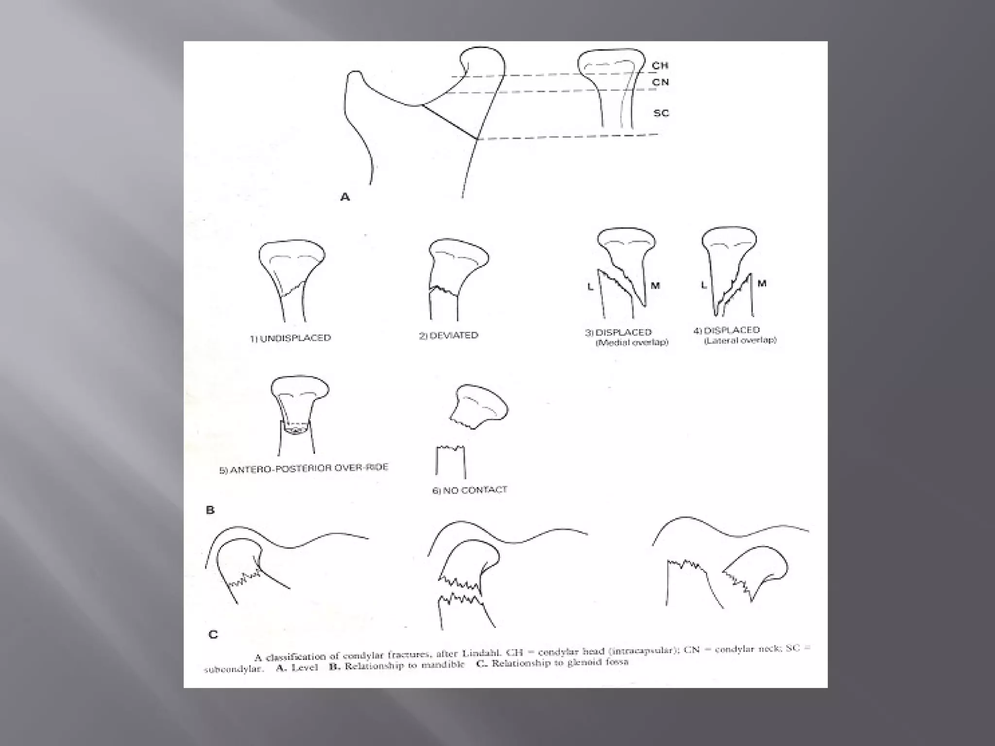 Condylar fractures | PPT