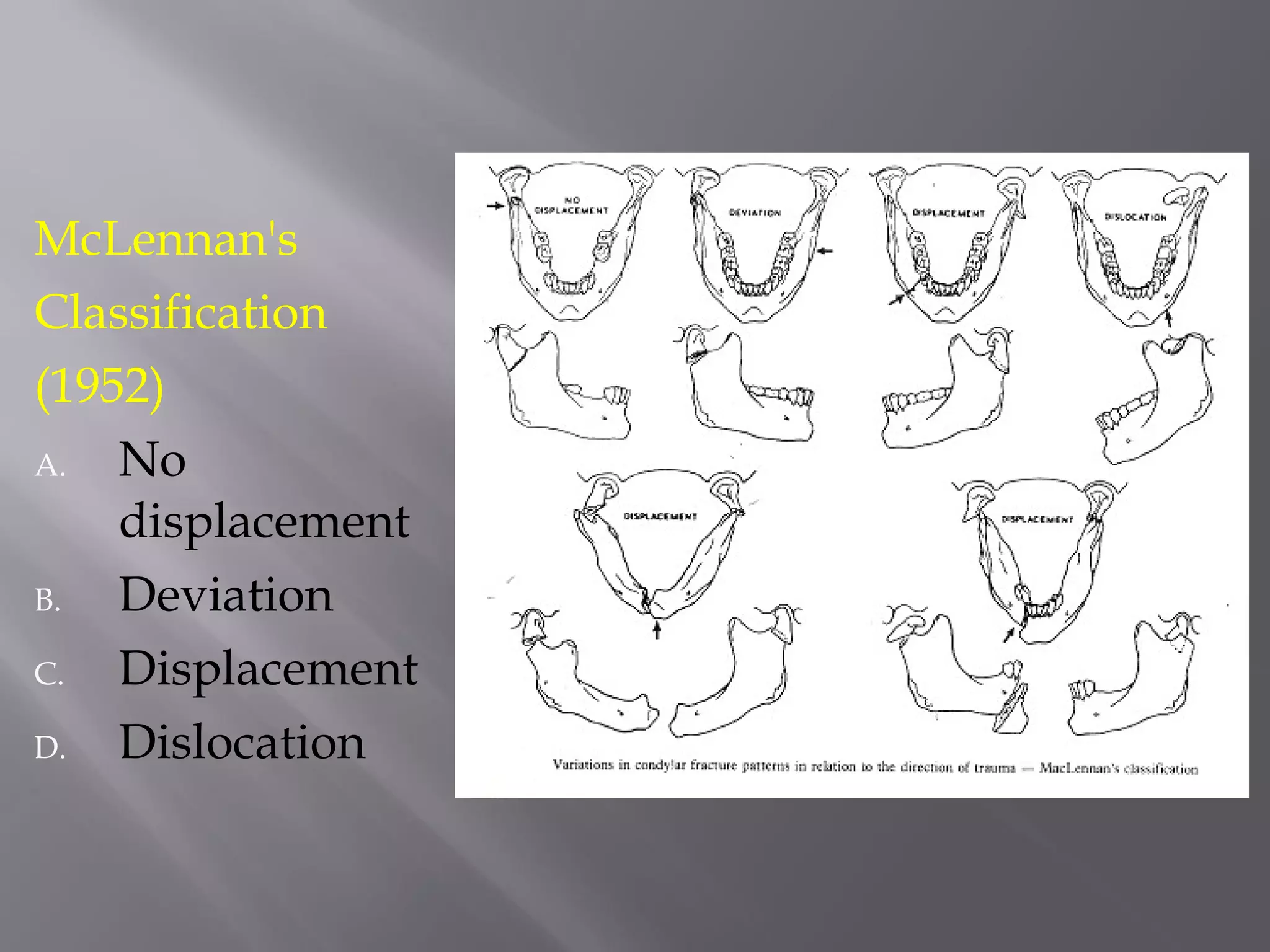 Condylar fractures | PPT