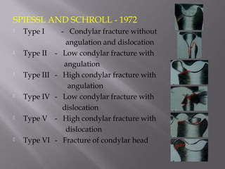 Condylar fractures | PPT
