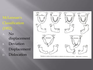 Condylar fractures | PPT