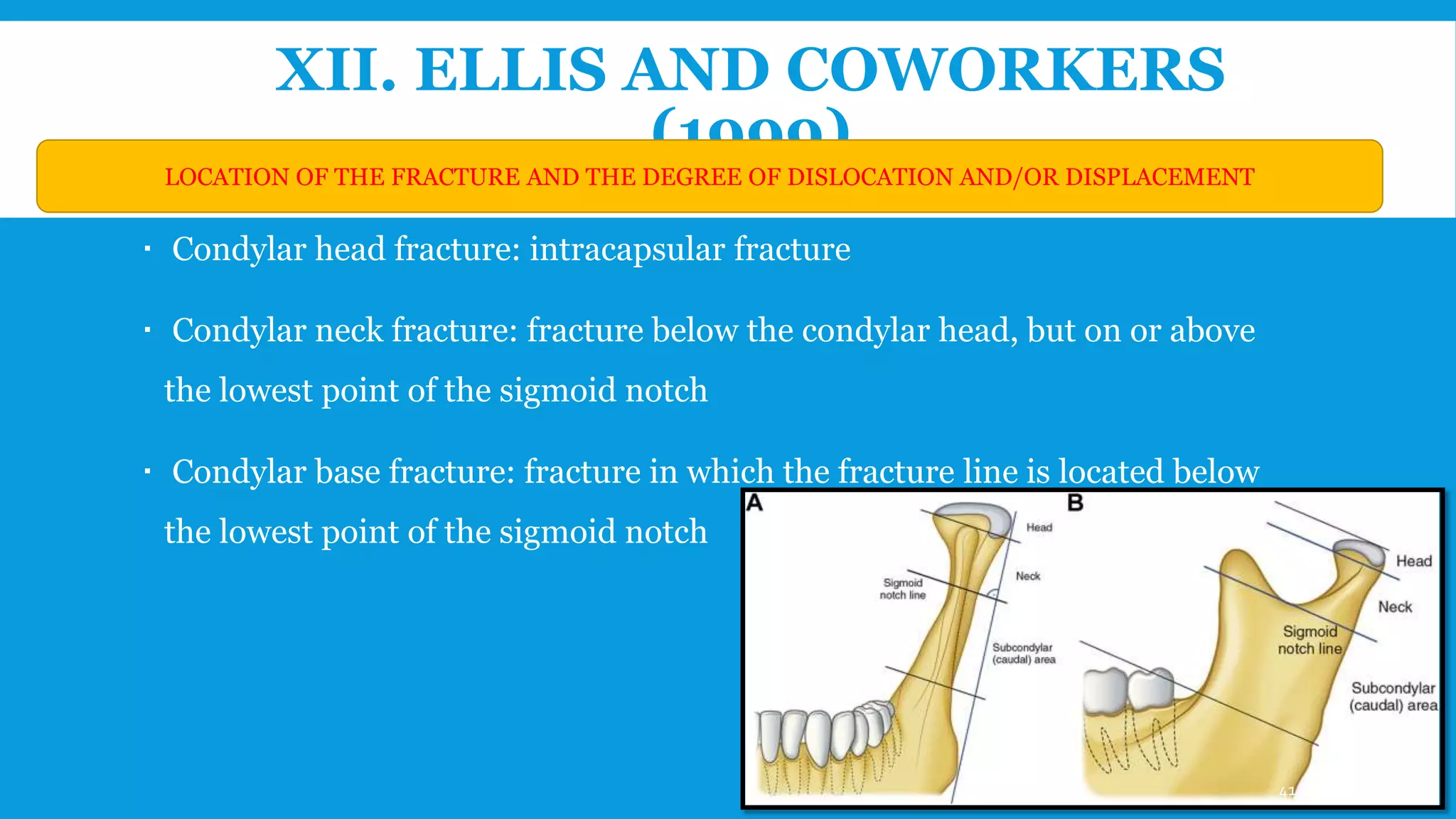 Condylar fractures | PPTX