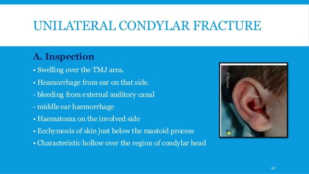 Condylar fractures