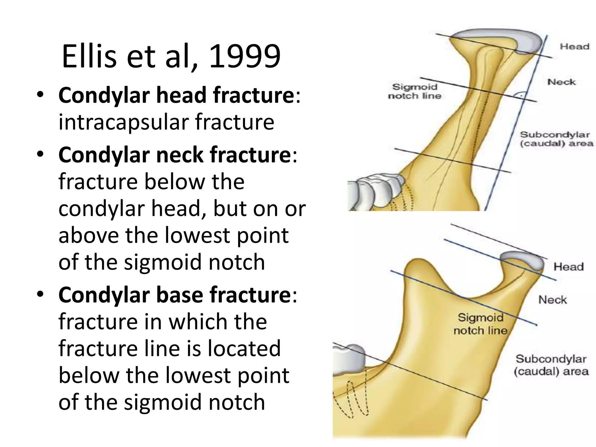 Mandibular Condylar fractures & its Management | PPTX