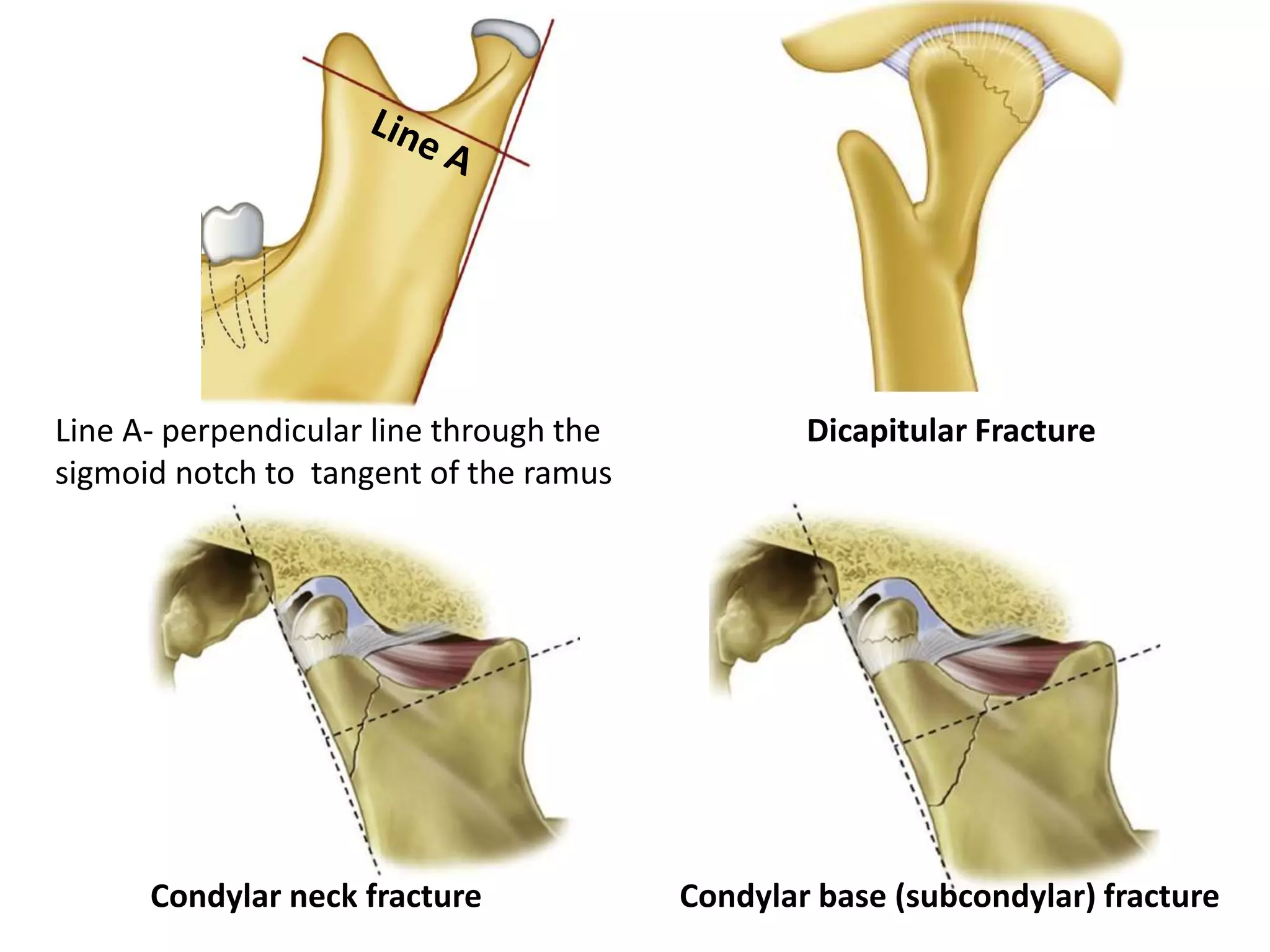 Mandibular Condylar fractures & its Management | PPTX