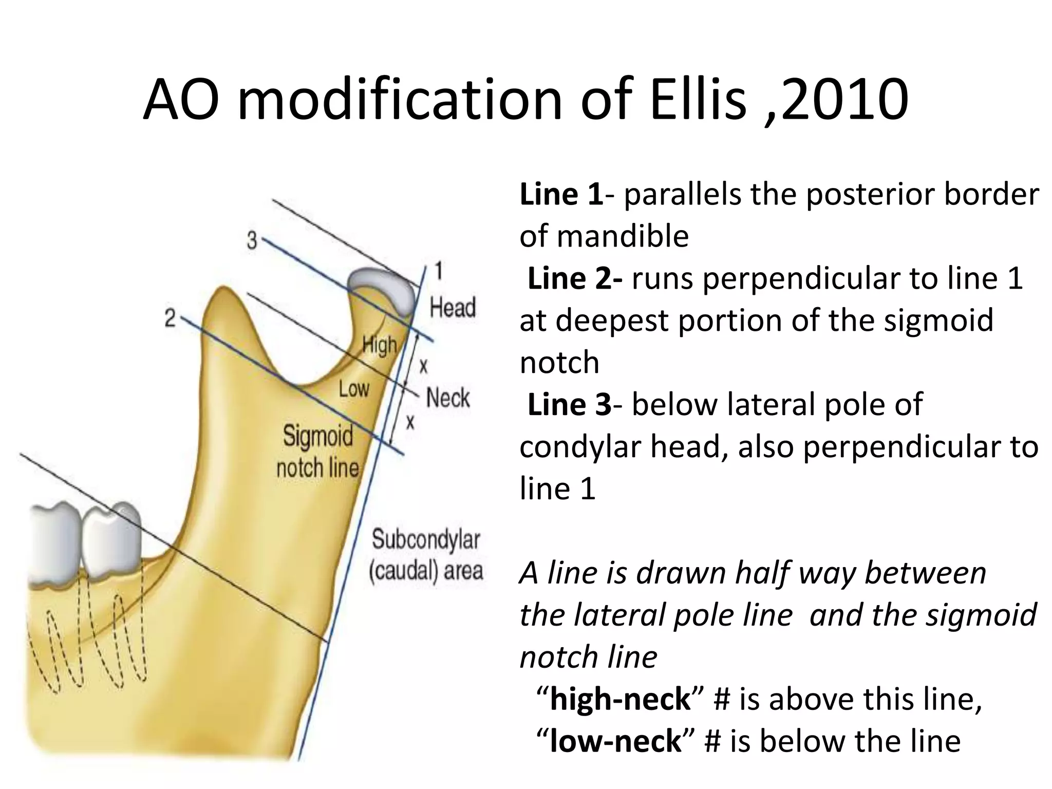 Mandibular Condylar fractures & its Management | PPTX
