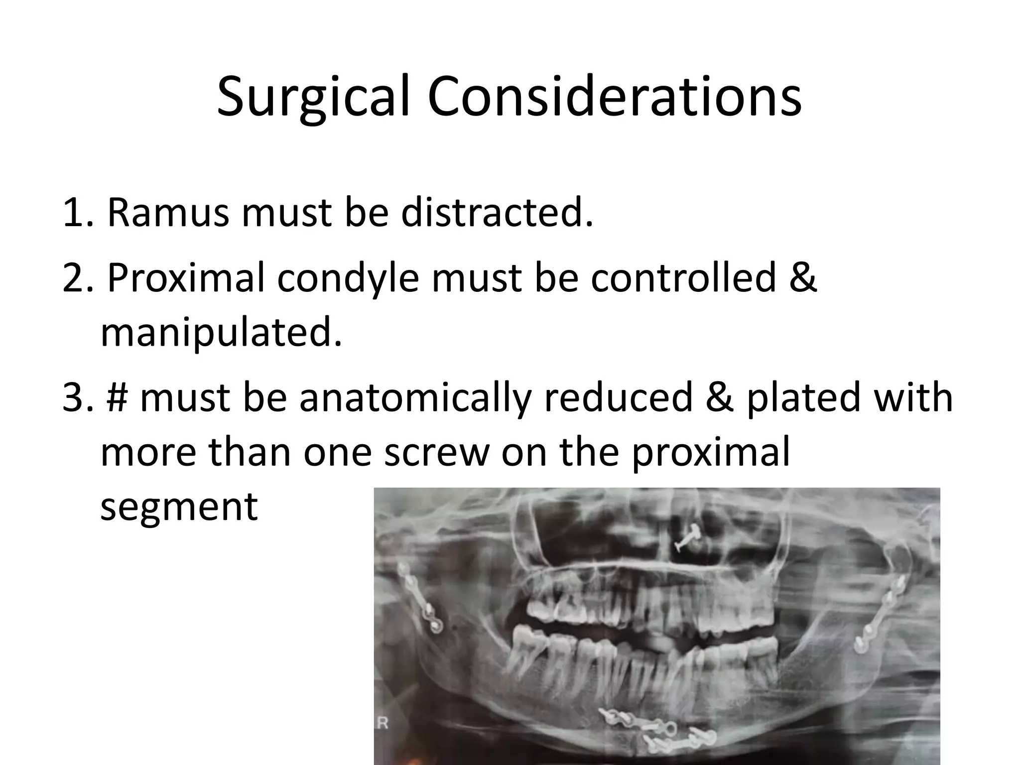 Mandibular Condylar fractures & its Management | PPTX