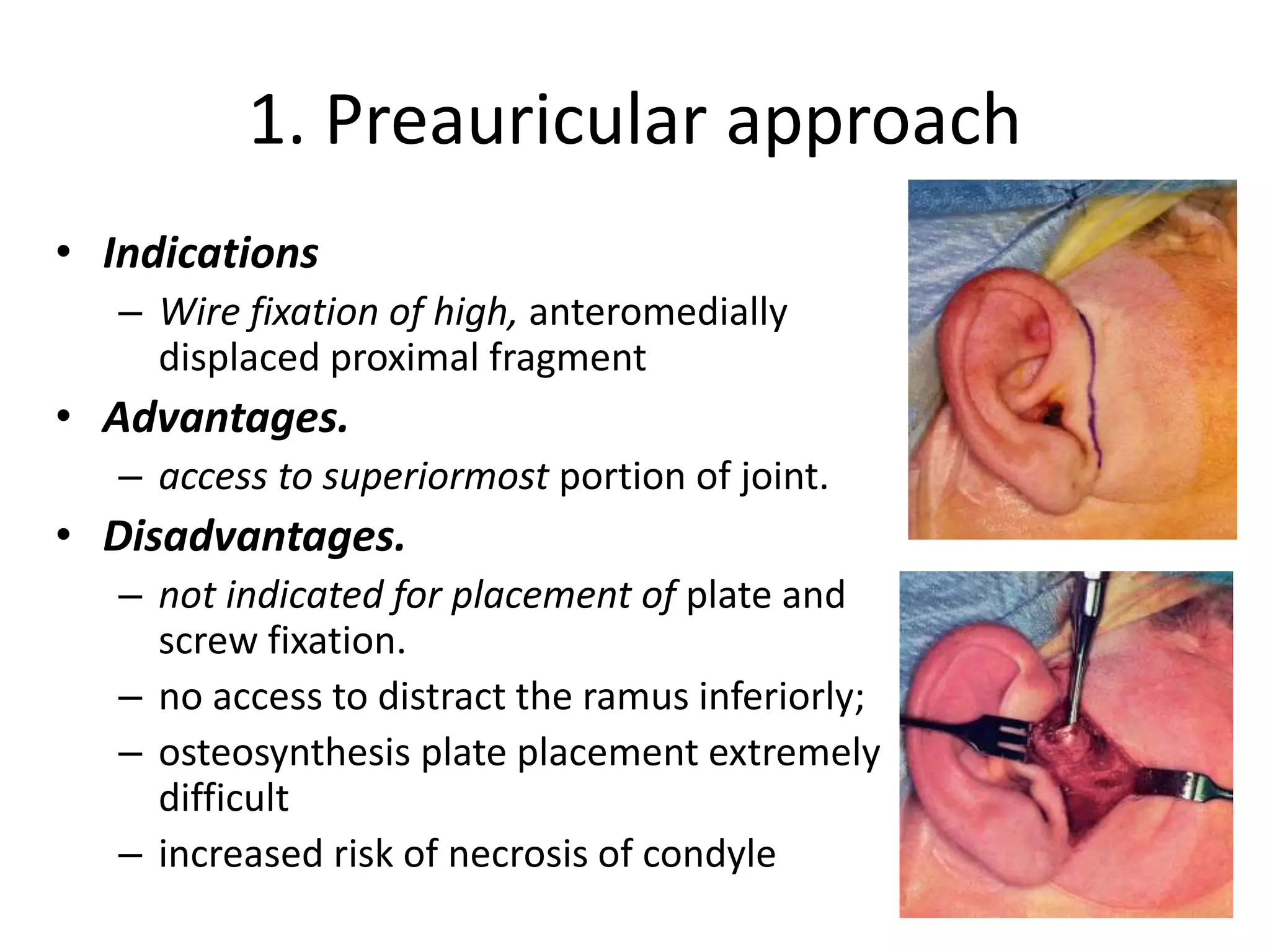 Mandibular Condylar fractures & its Management | PPTX