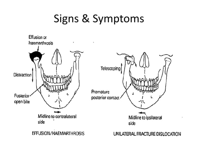 Mandibular Condylar fractures & its Management | PPTX | Death, Injury ...