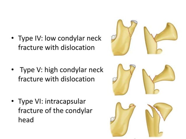 Mandibular Condylar fractures & its Management | PPTX | Death, Injury ...