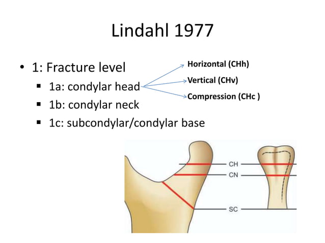 Mandibular Condylar fractures & its Management | PPTX | Death, Injury ...