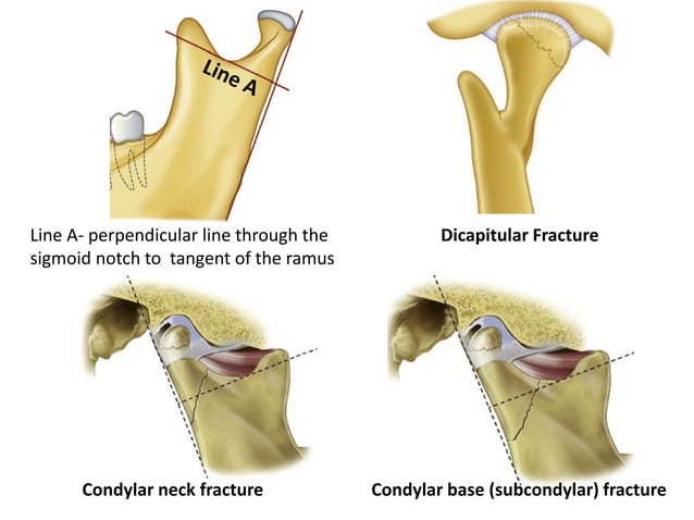 Mandibular Condylar fractures & its Management | PPTX | Death, Injury ...
