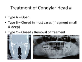 Mandibular Condylar fractures & its Management | PPTX