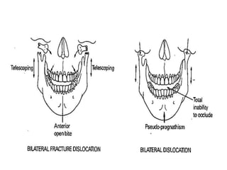 Mandibular Condyle Fractures Jaw Chin Fractured Unopposed Eminence ...
