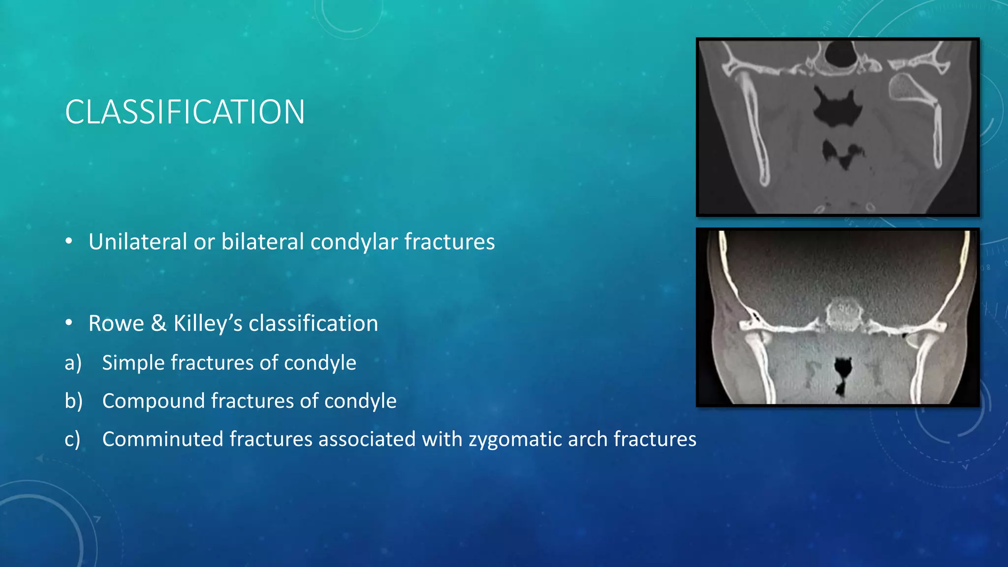 Condylar fractures | PPTX