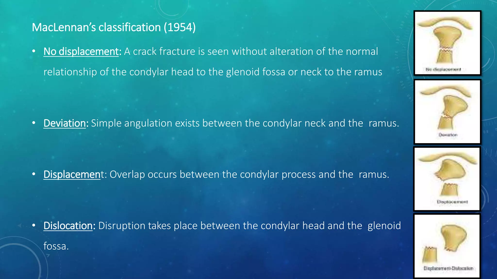 Condylar fractures | PPTX