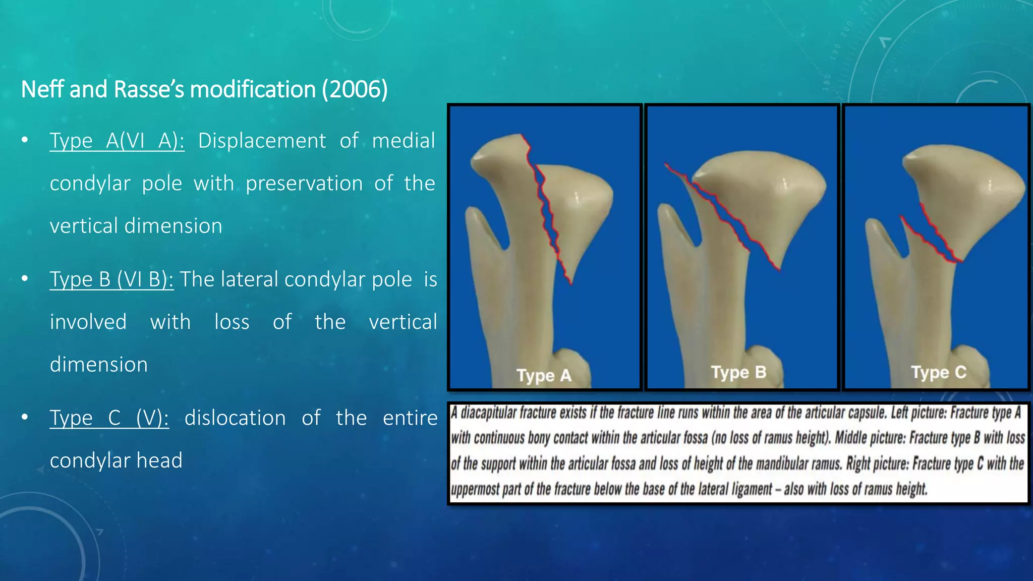 Condylar fractures | PPTX