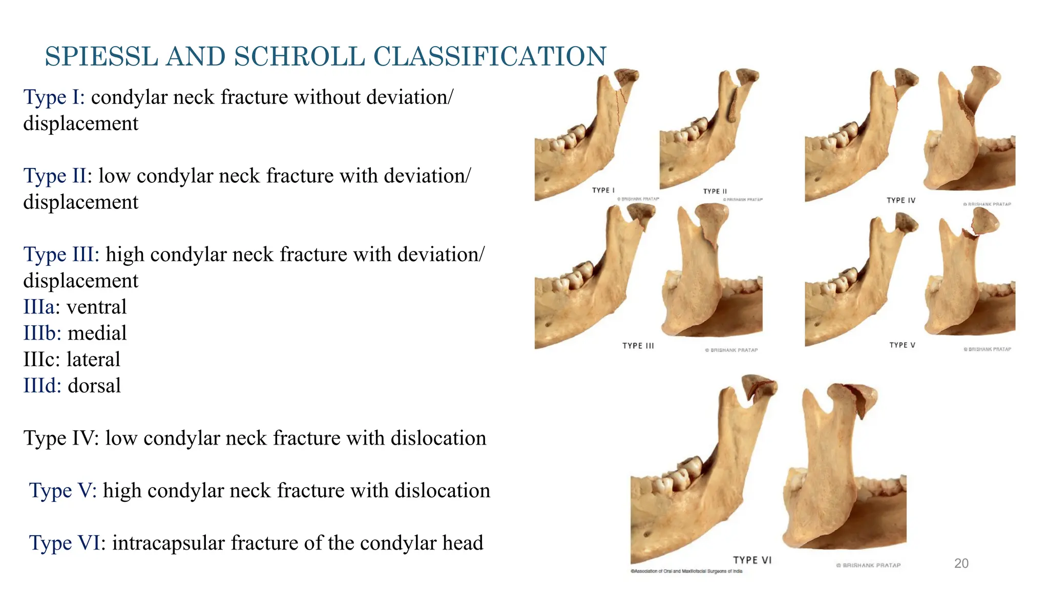 CONDYLAR FRACTURES AND ITS MANAGEMENT.pptx