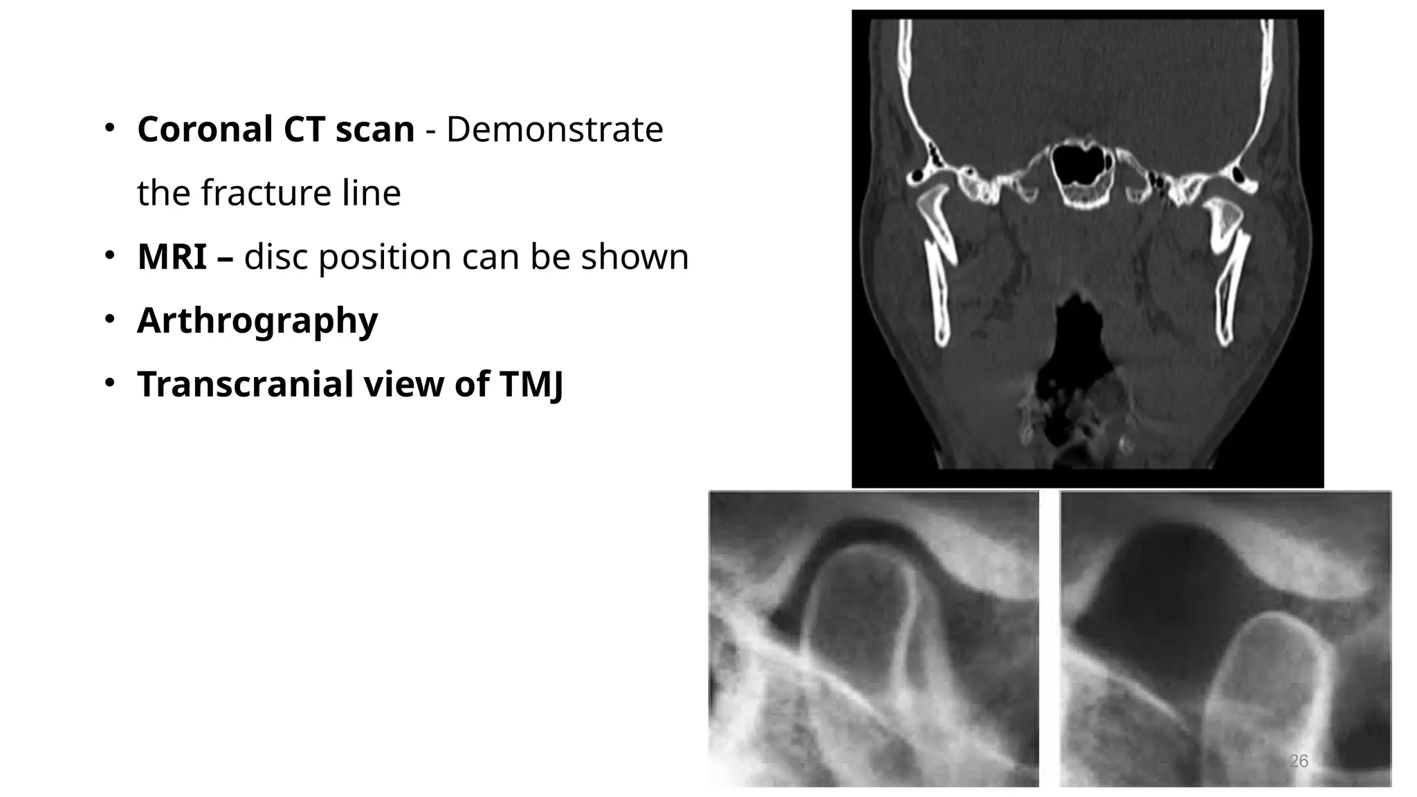 CONDYLAR FRACTURES AND ITS MANAGEMENT.pptx