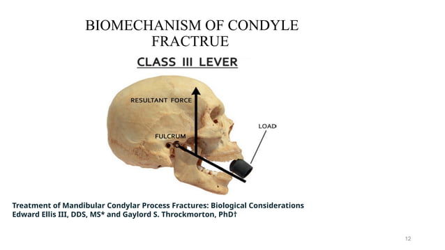 Condylar Fractures And Its Managementpptx
