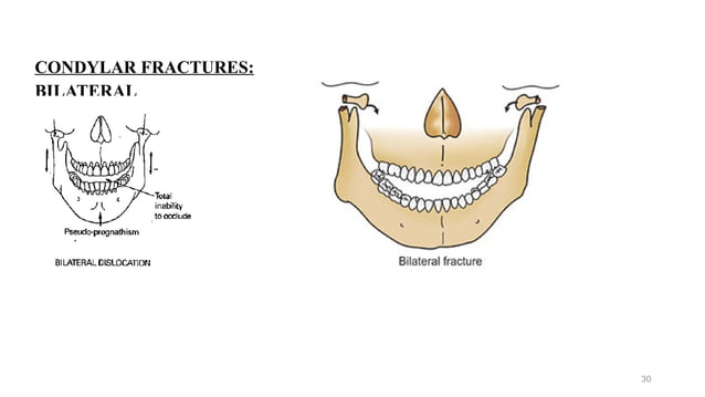 CONDYLAR FRACTURES AND ITS MANAGEMENT.pptx