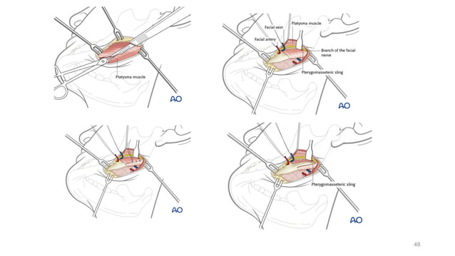 Condylar Fractures And Its Managementpptx
