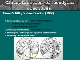 Condylar fractures 2 /certified fixed orthodontic courses by Indian ...