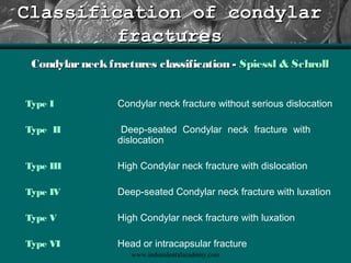 Condylar fractures 2 /certified fixed orthodontic courses by Indian ...
