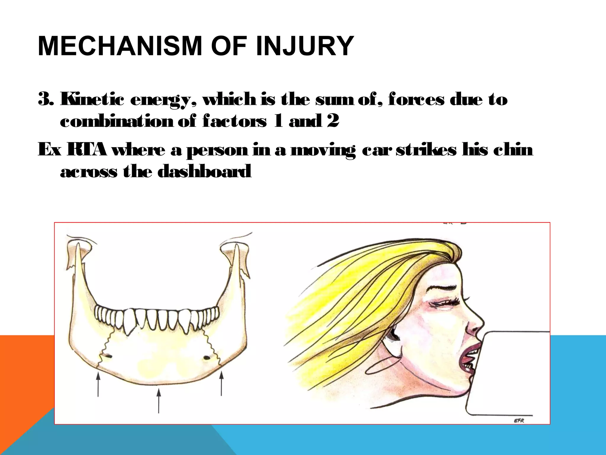 Condylar Fractures Ppt