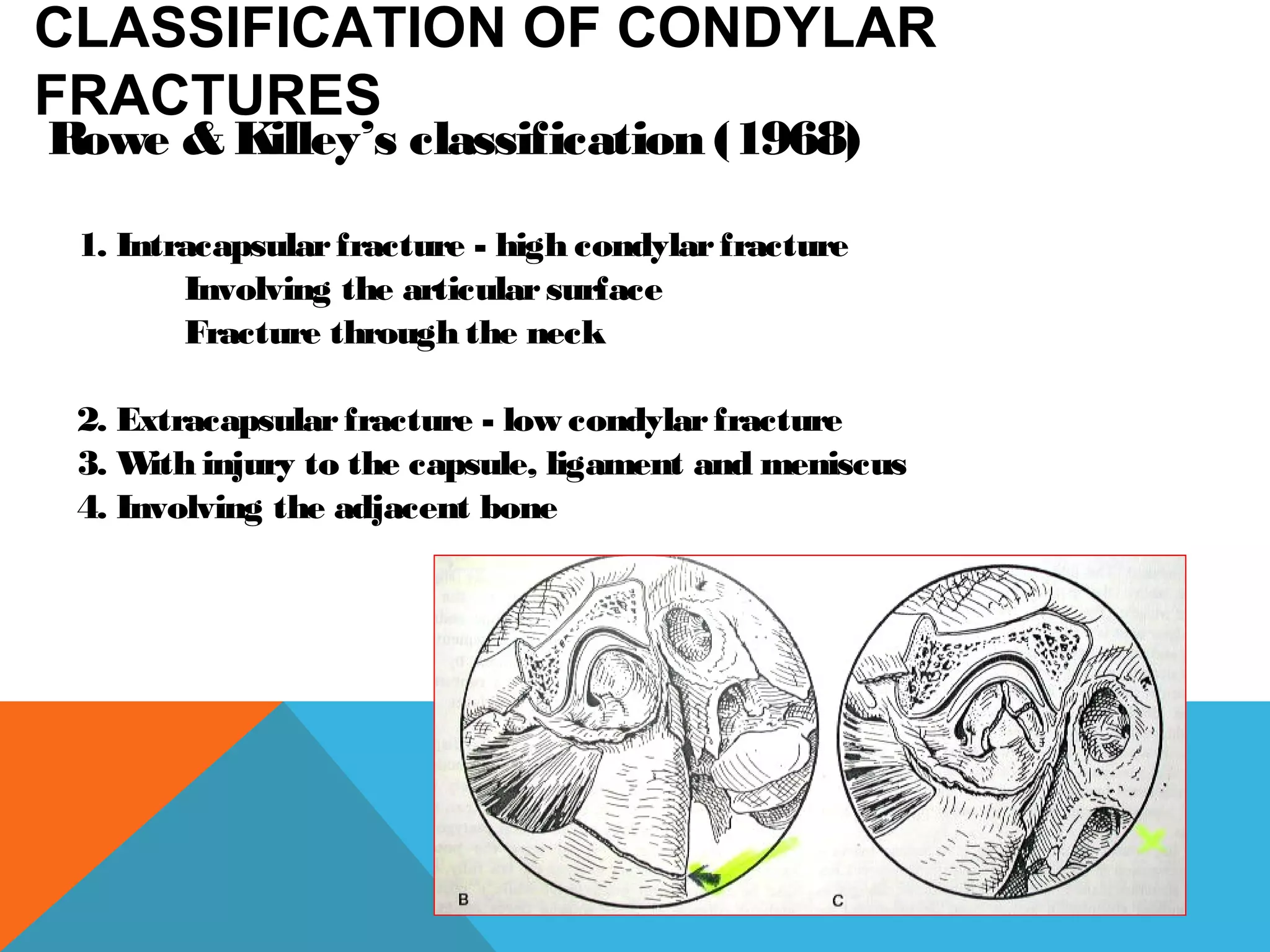 Condylar fractures | PPT
