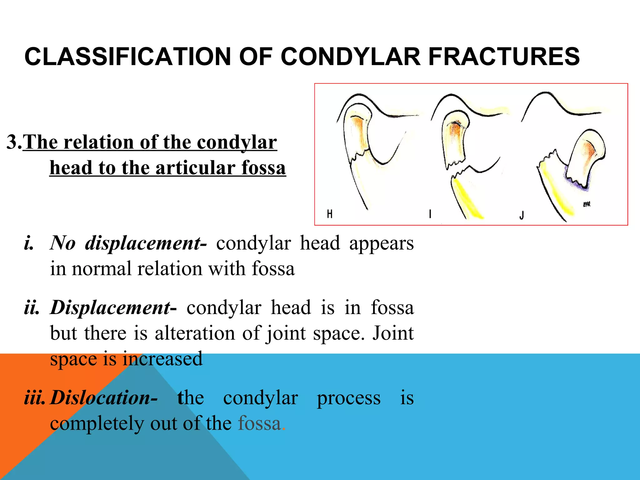 Condylar fractures | PPT