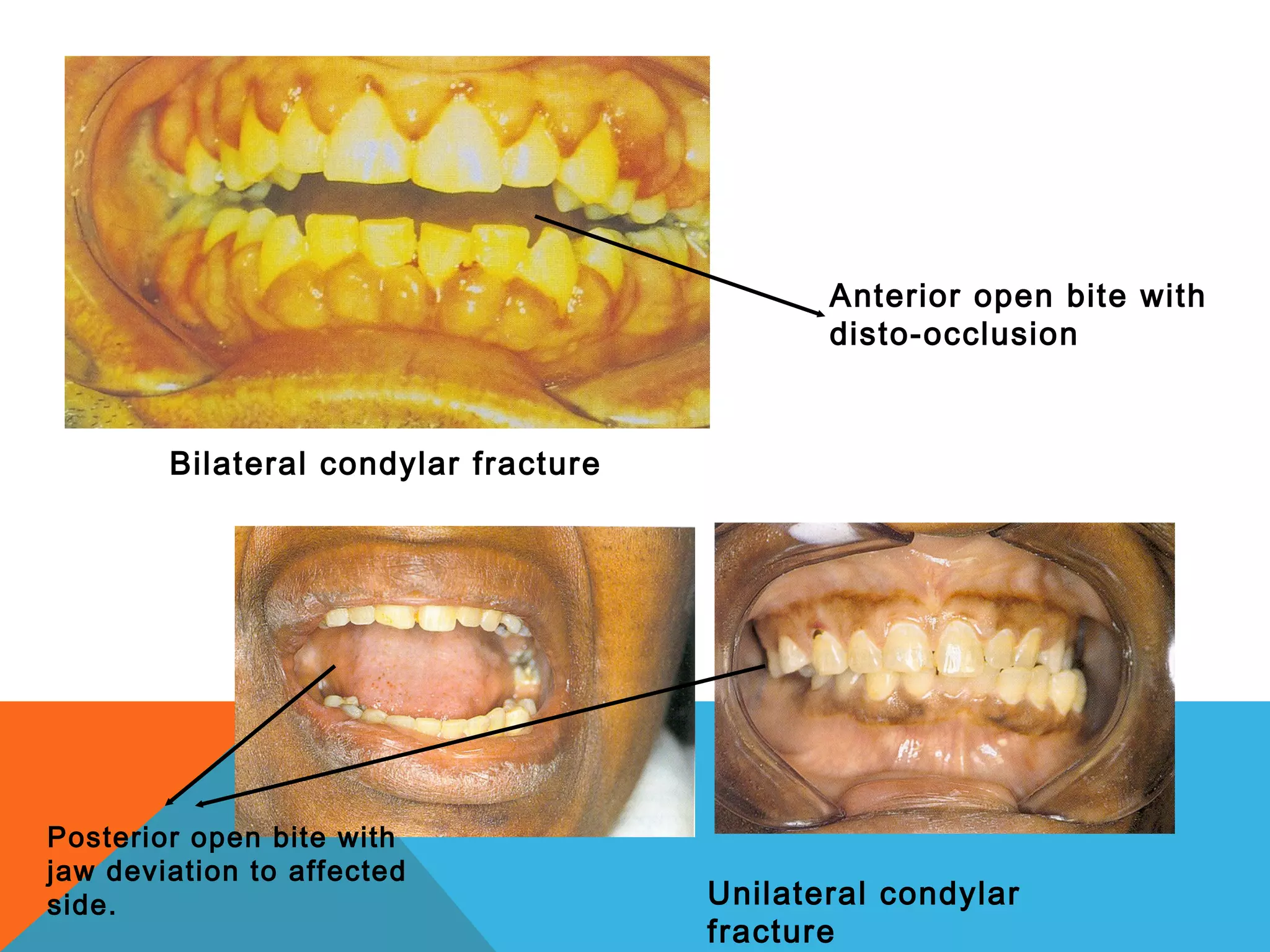 Condylar fractures | PPT