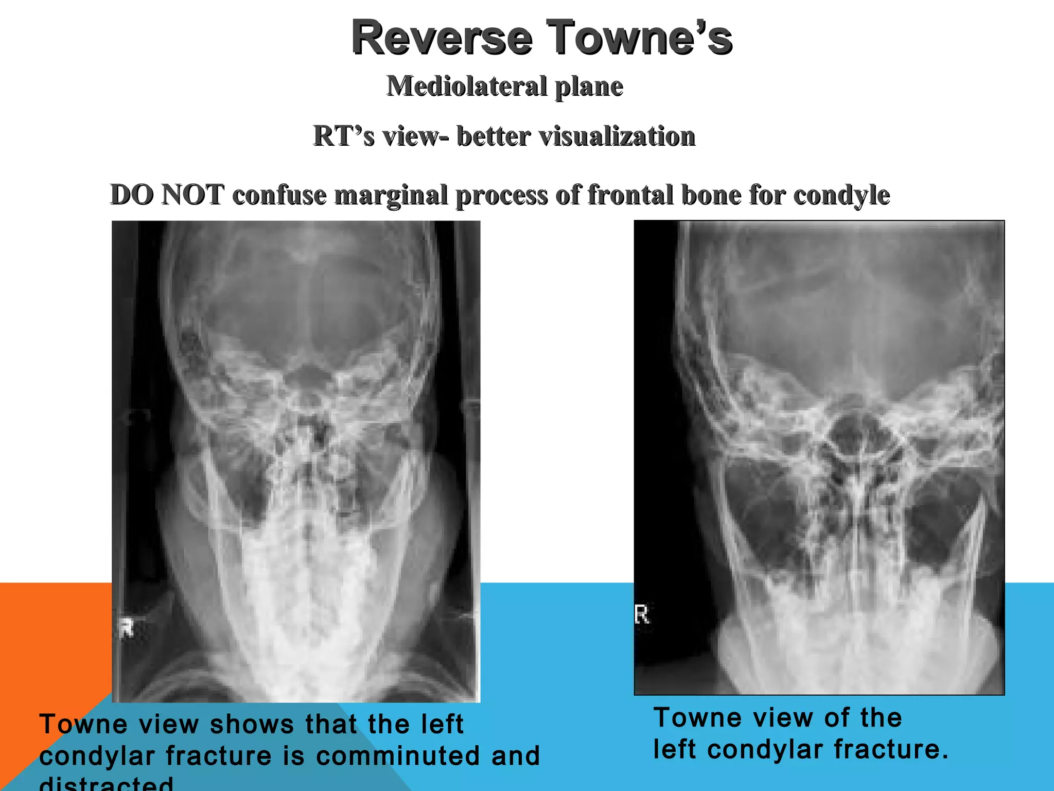 Condylar fractures | PPT