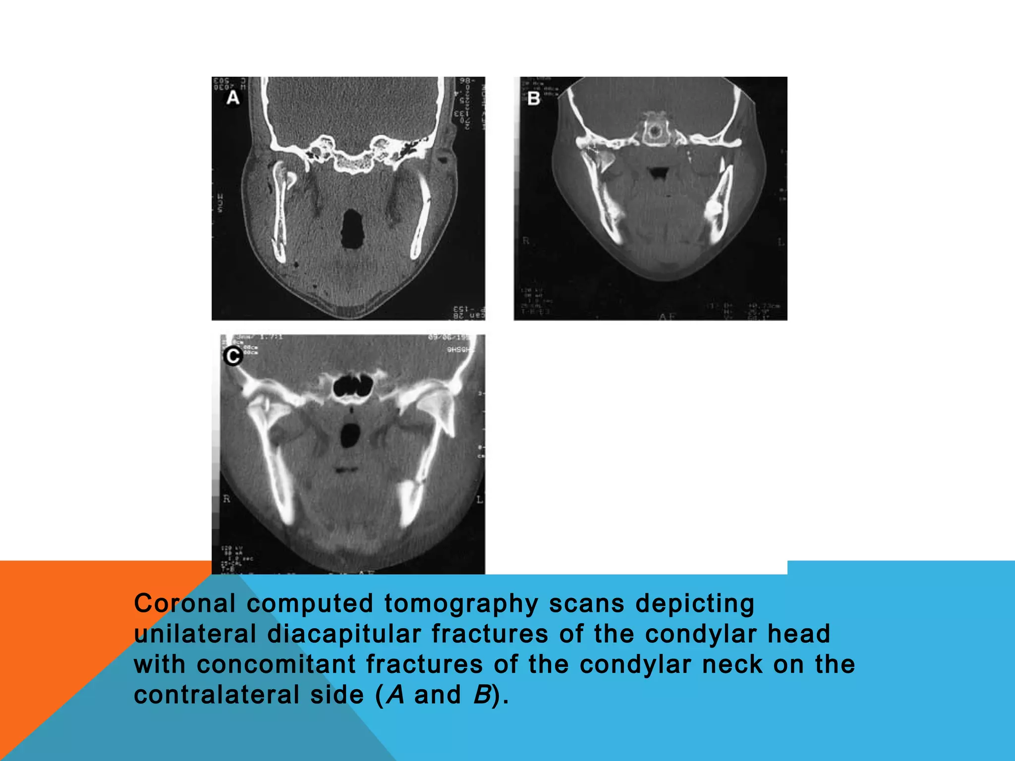 Condylar fractures | PPT