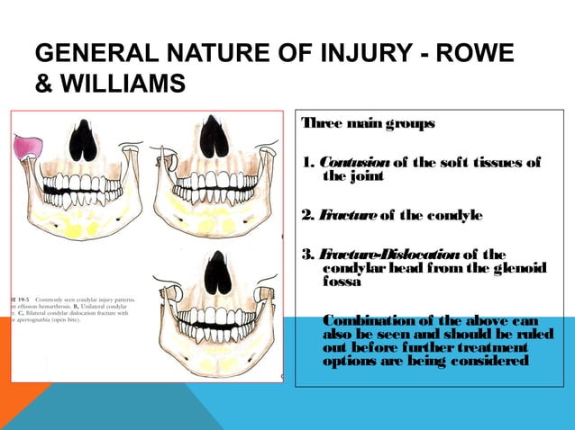 Condylar Fractures Ppt