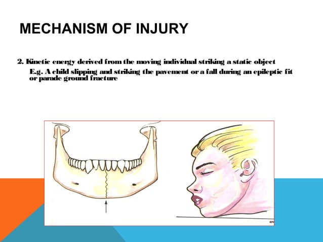 Condylar Fractures Ppt