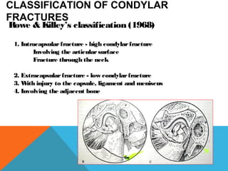 Condylar fractures | PPT