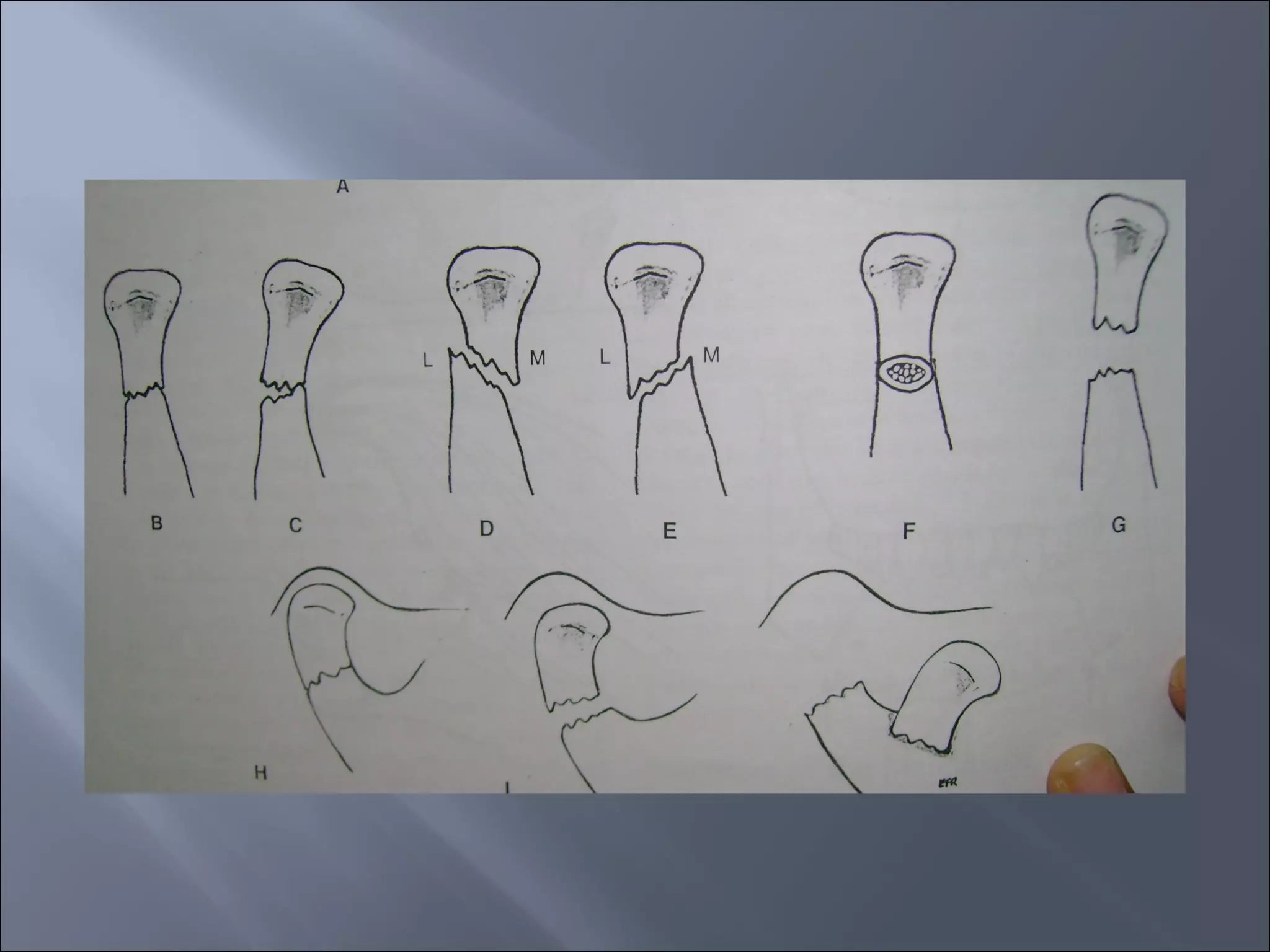 Condylar fractures ih | PPT