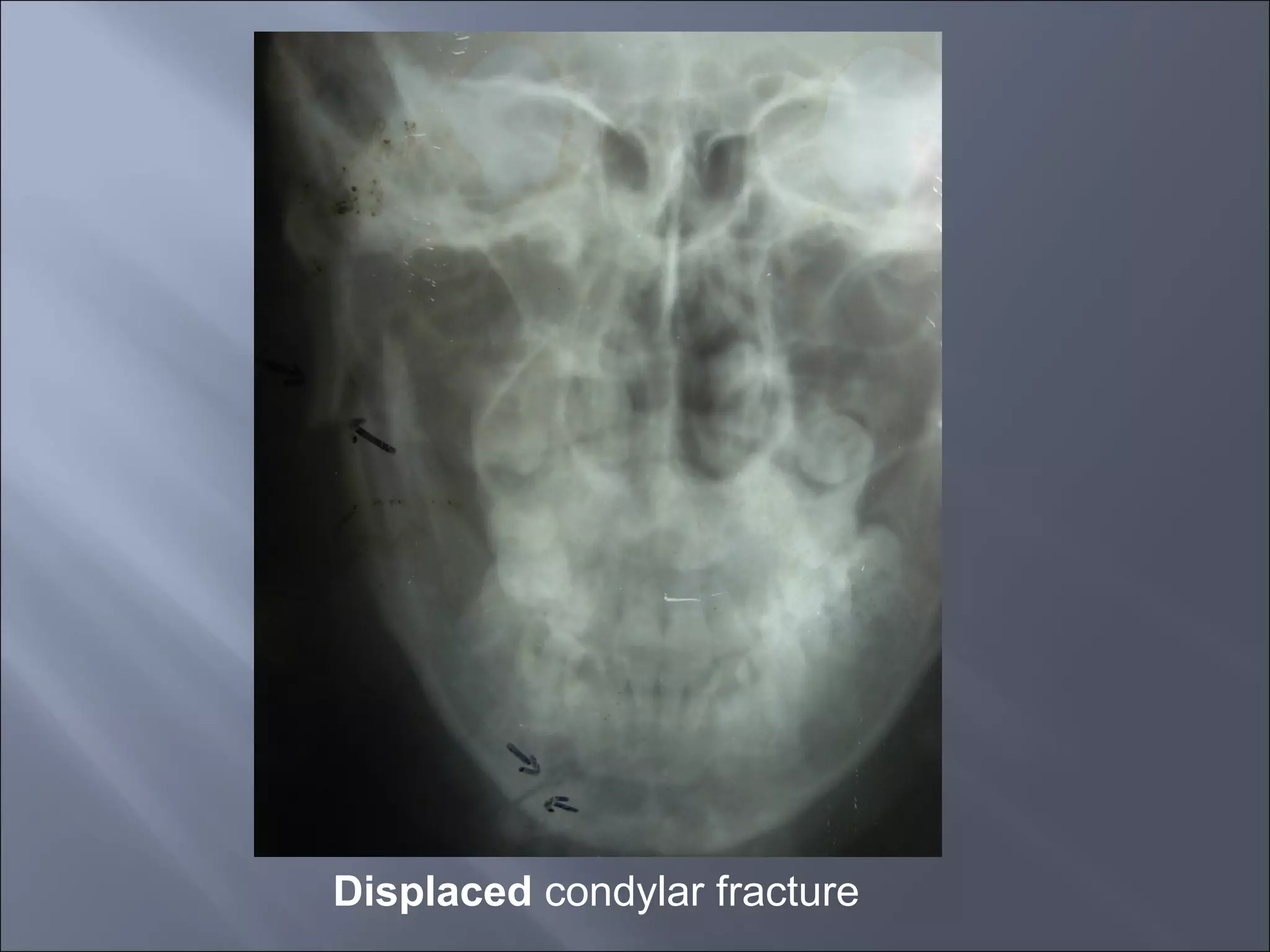 Condylar fractures ih | PPT
