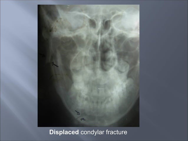 Condylar fractures ih | PPT | Death, Injury, or Military Conflict ...